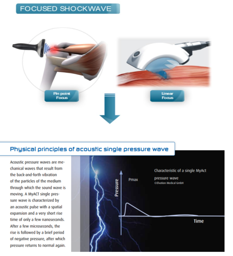 Piezowave Pain Treatment | Acoustic Compression Therapy